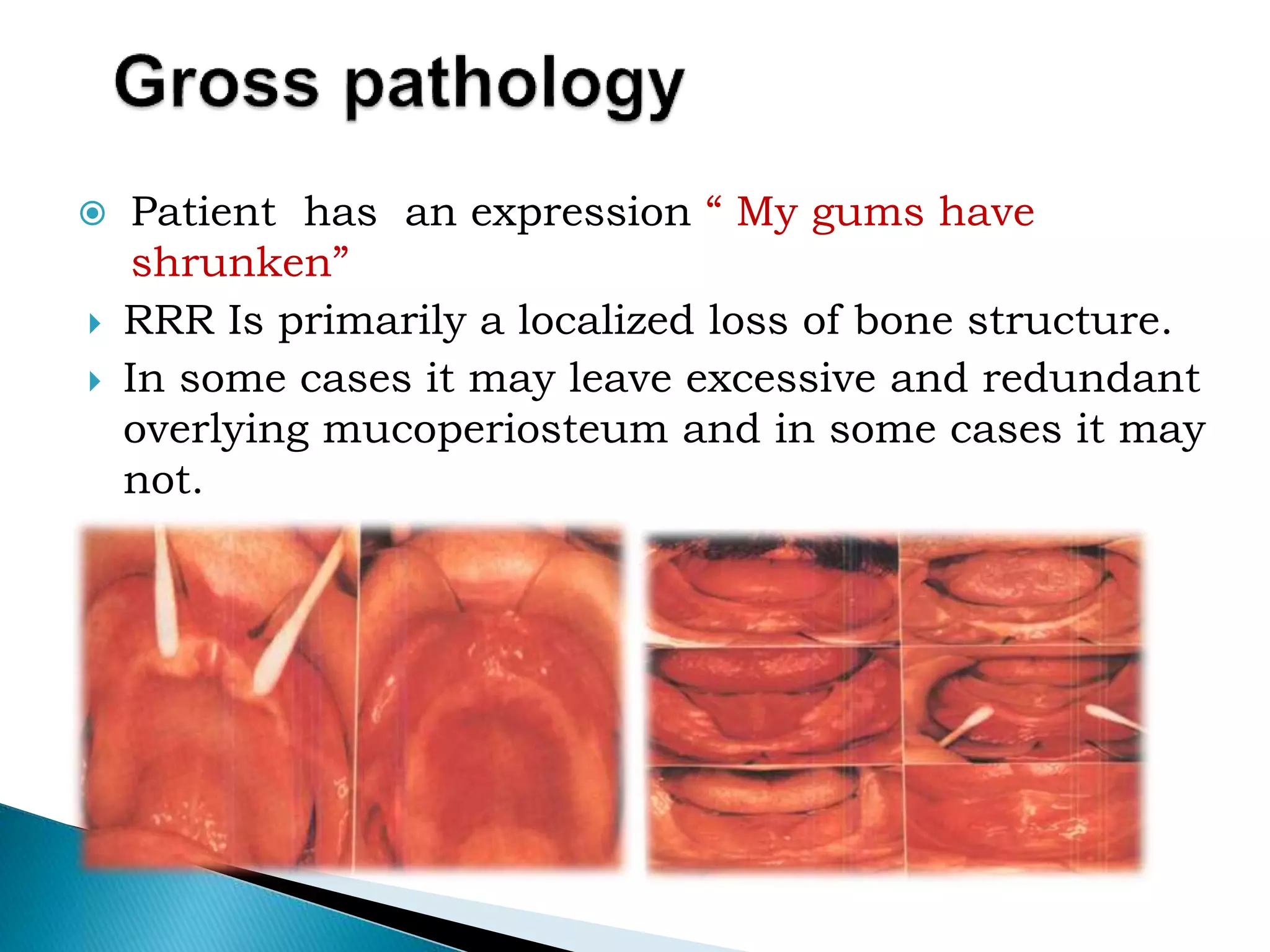 Residual ridge resorption | PPTX | Bone and Joint Conditions | Diseases ...