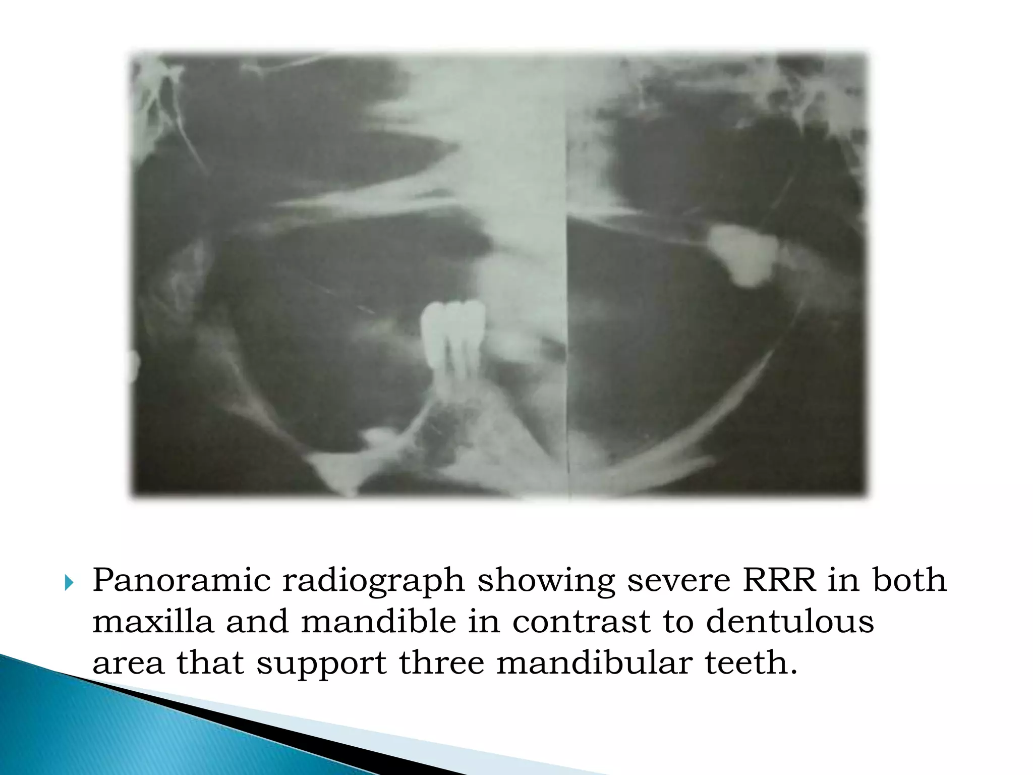 Residual ridge resorption | PPTX | Bone and Joint Conditions | Diseases ...
