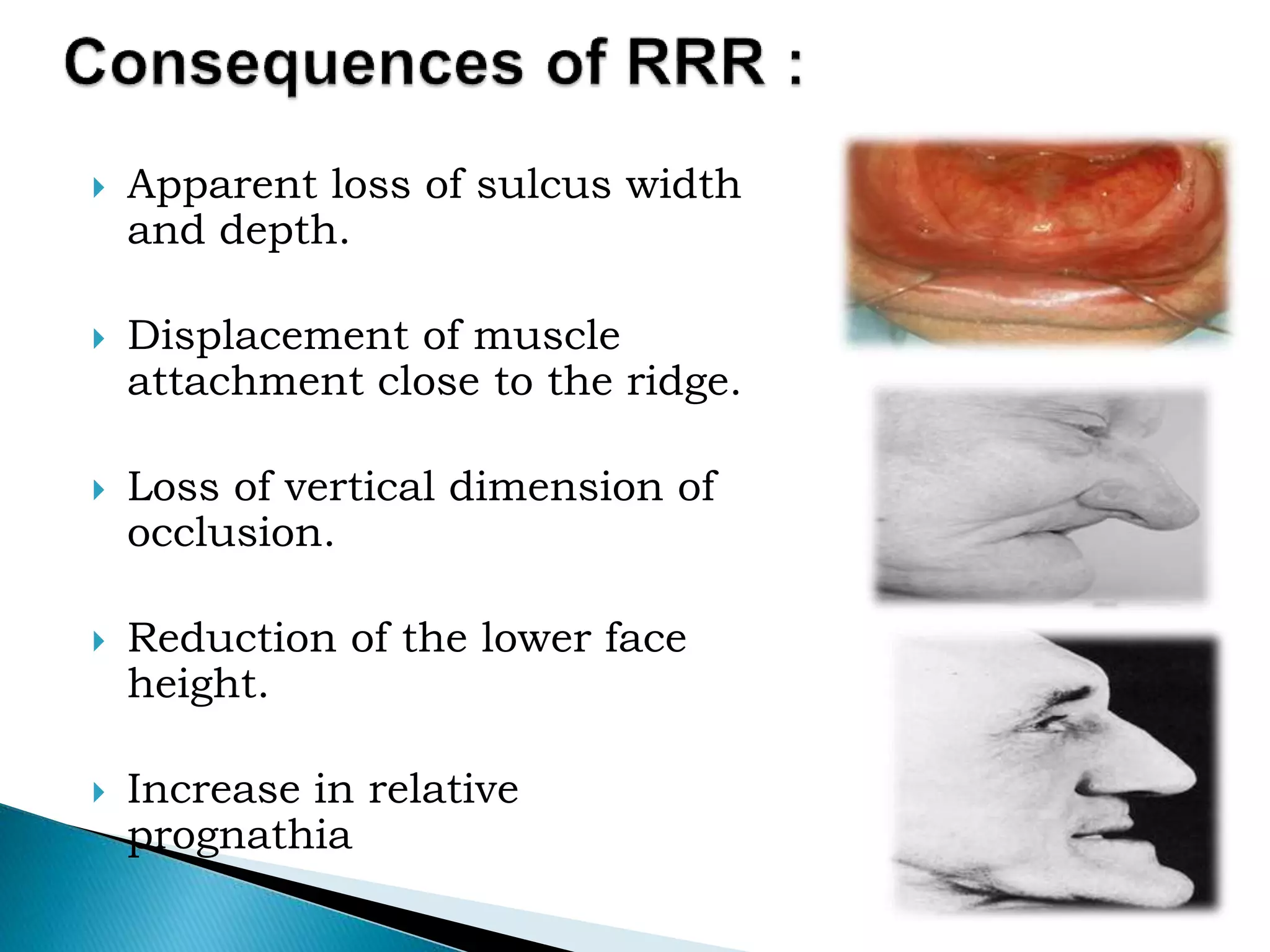 Residual ridge resorption | PPTX
