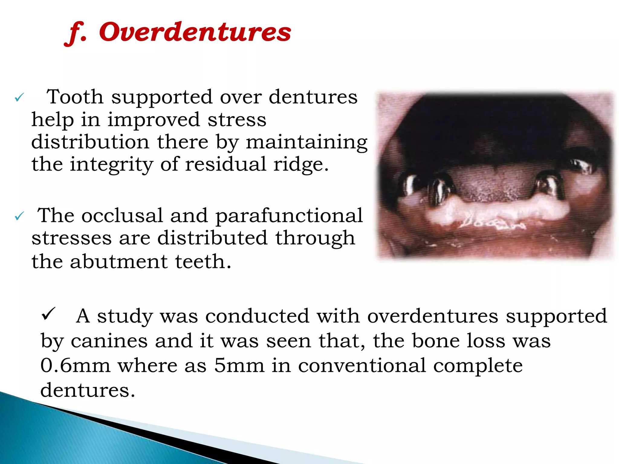 Residual ridge resorption | PPTX