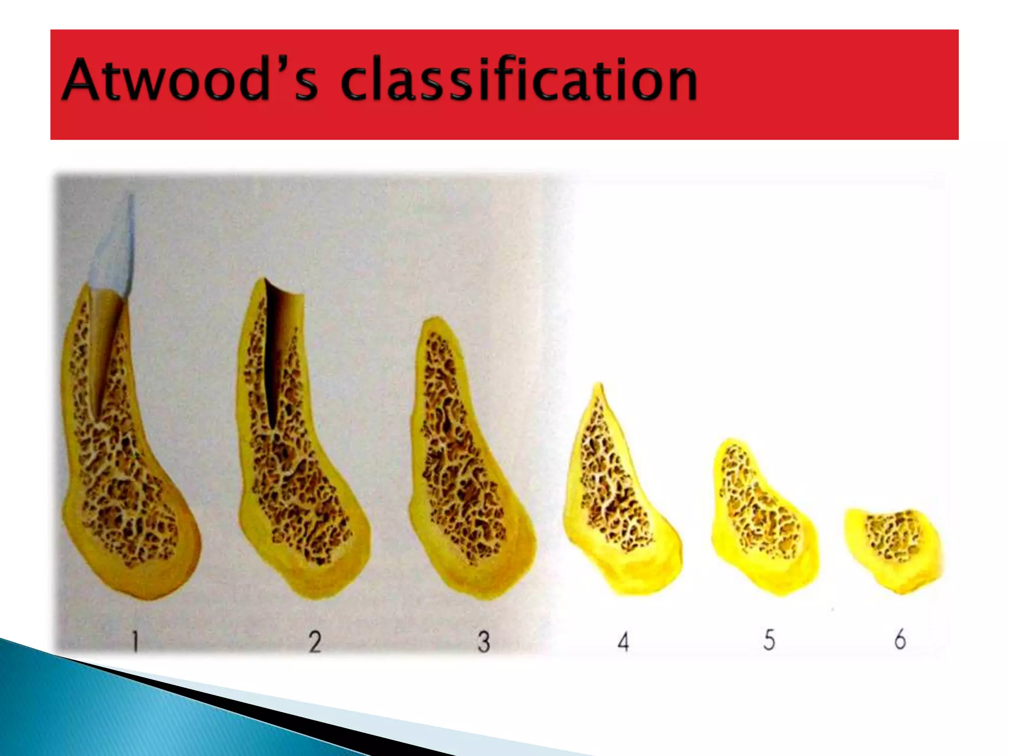 Residual ridge resorption | PPTX