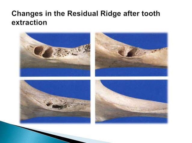 Residual ridge resorption | PPTX | Bone and Joint Conditions | Diseases ...