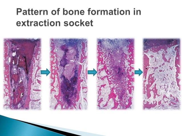 Residual ridge resorption | PPTX | Bone and Joint Conditions | Diseases ...