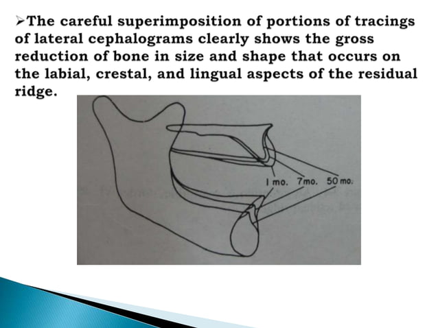 Residual ridge resorption | PPTX | Bone and Joint Conditions | Diseases ...