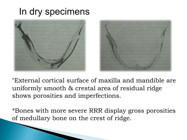 Residual ridge resorption | PPTX | Bone and Joint Conditions | Diseases ...