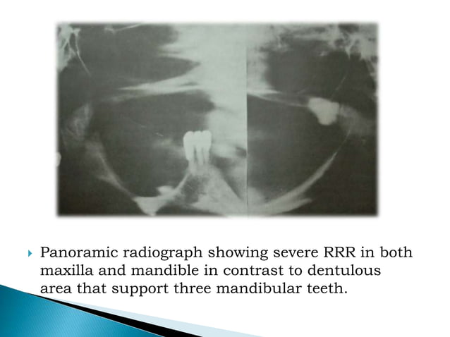 Residual ridge resorption | PPTX | Bone and Joint Conditions | Diseases ...