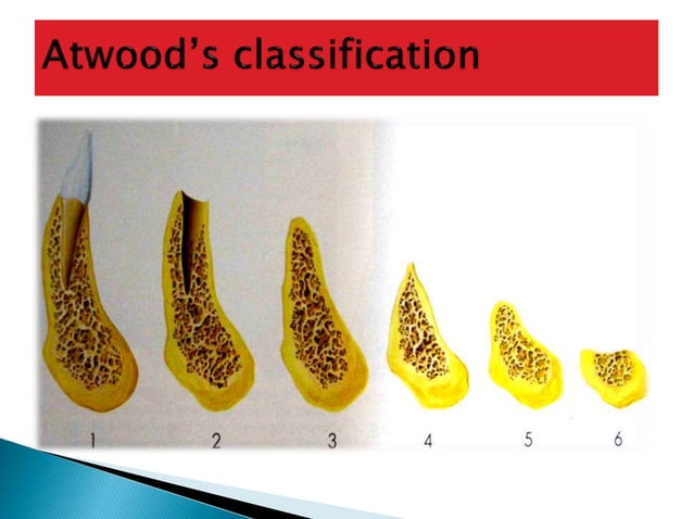 Residual ridge resorption | PPTX | Bone and Joint Conditions | Diseases ...