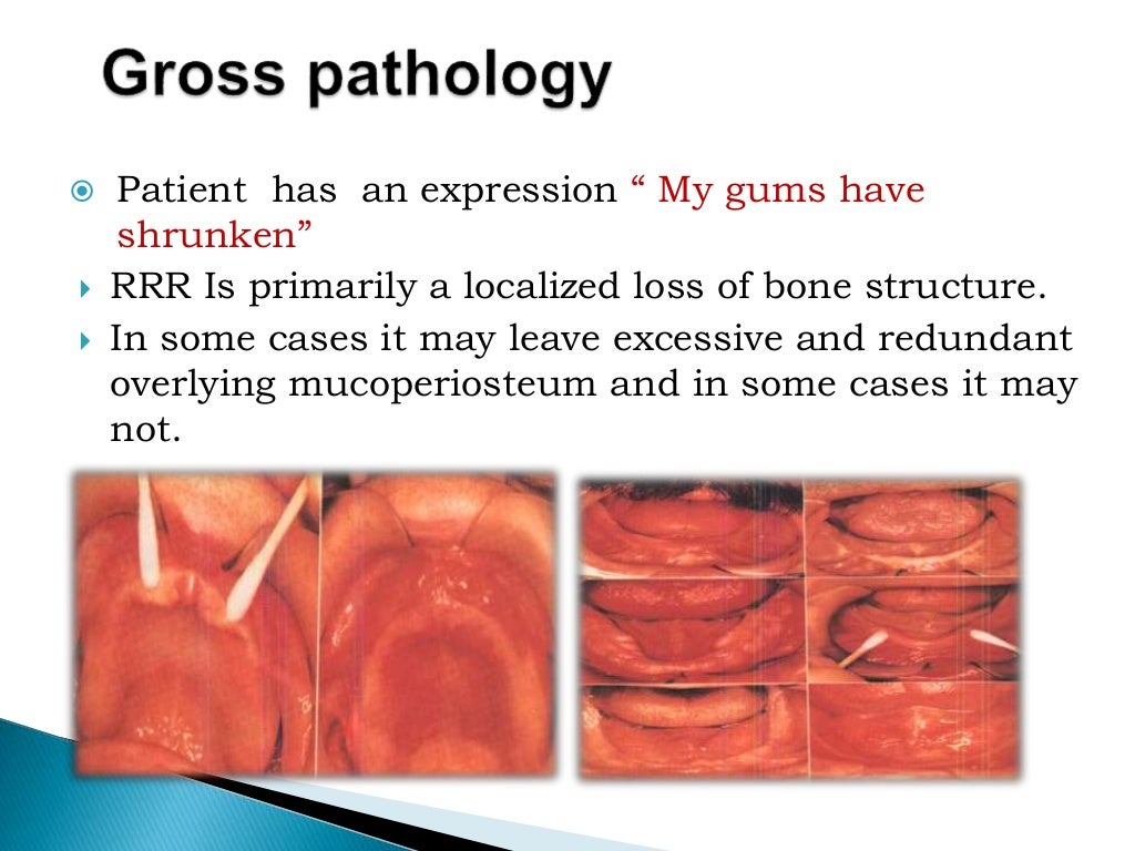 Residual ridge resorption