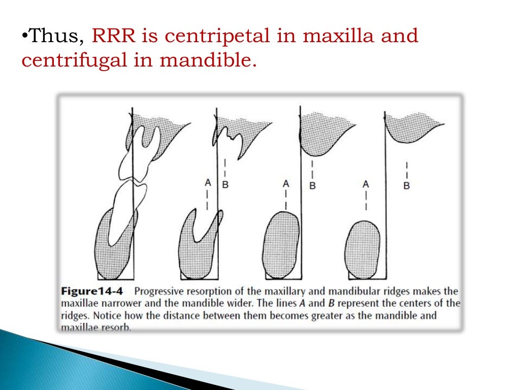 Residual ridge resorption