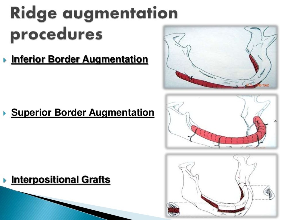 Residual ridge resorption