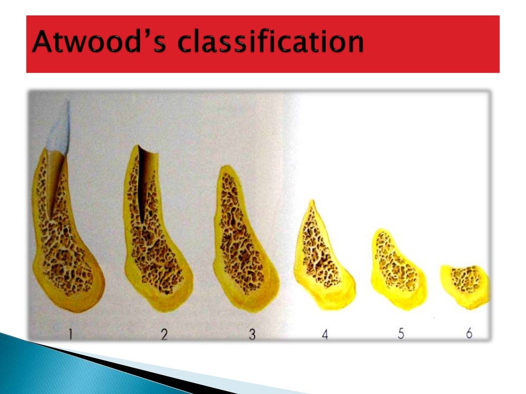 Residual ridge resorption