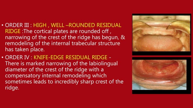 Residual ridge resorption | PPTX | Dental Health | Diseases and Conditions