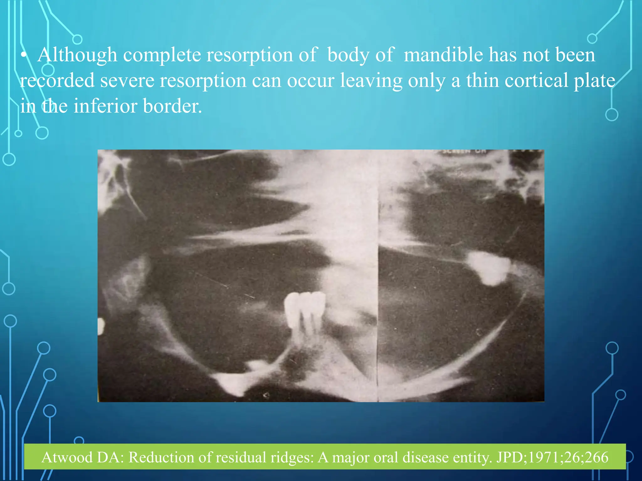 residual ridge resorption in cd patients | PPT