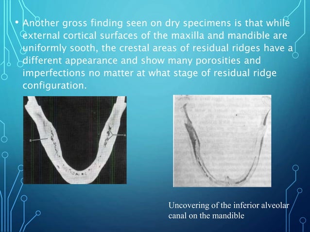 residual ridge resorption in cd patients | PPT