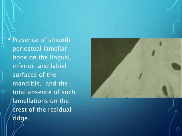 residual ridge resorption in cd patients | PPT