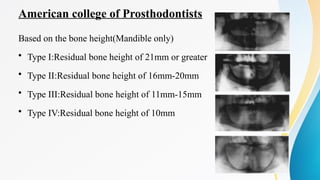 Residual ridge resorption and managemnt of resorbed ridges | PPTX
