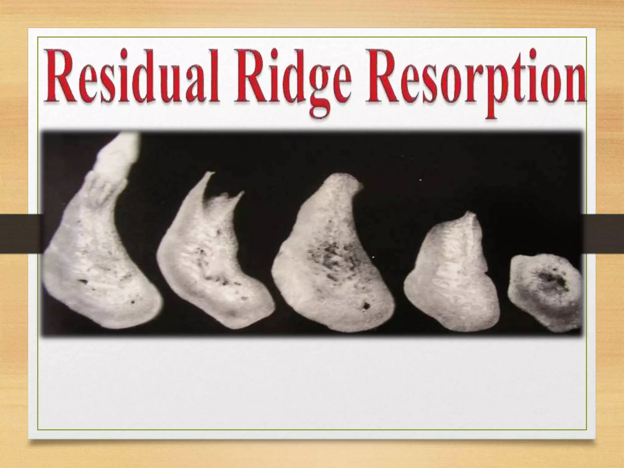 Residual ridge resorption | PPTX