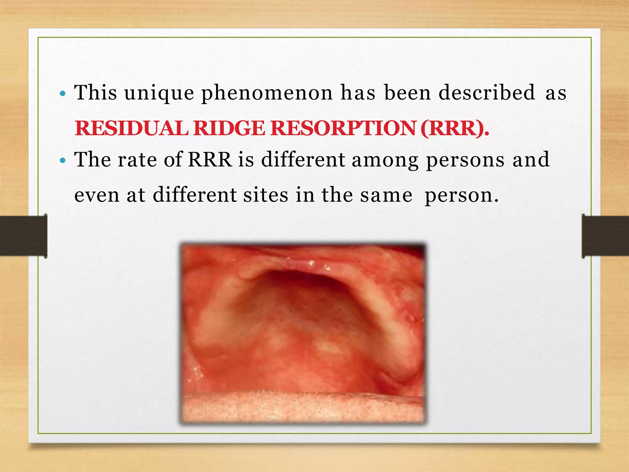 Residual ridge resorption | PPTX