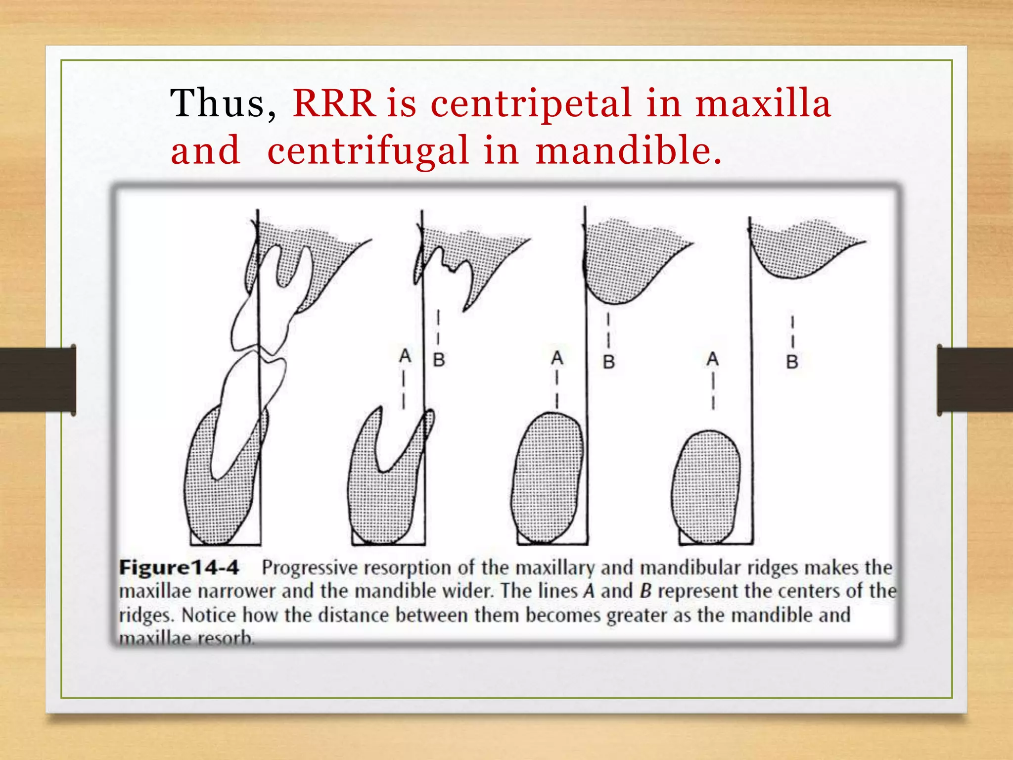 Residual ridge resorption | PPTX