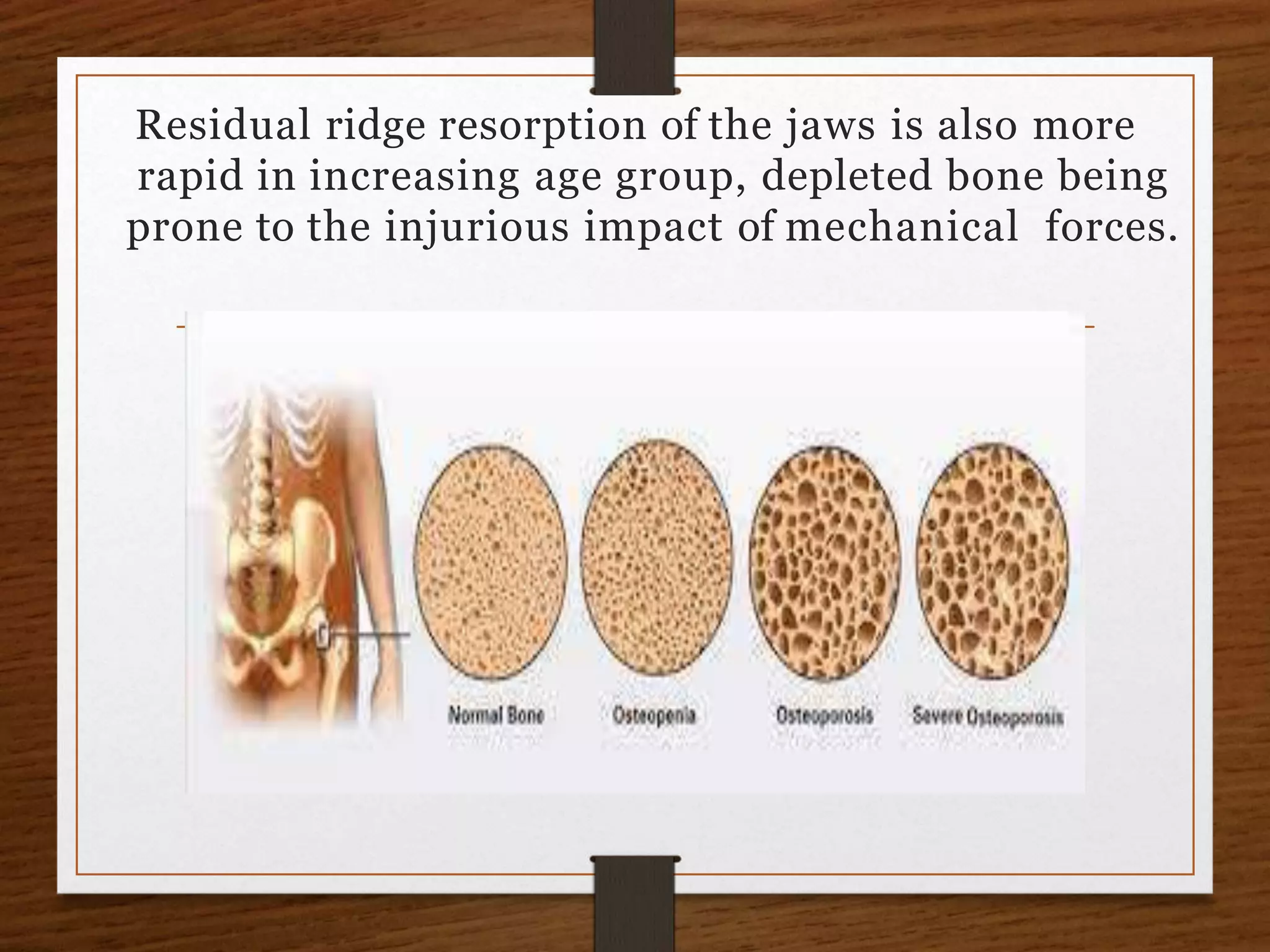 Residual ridge resorption | PPTX