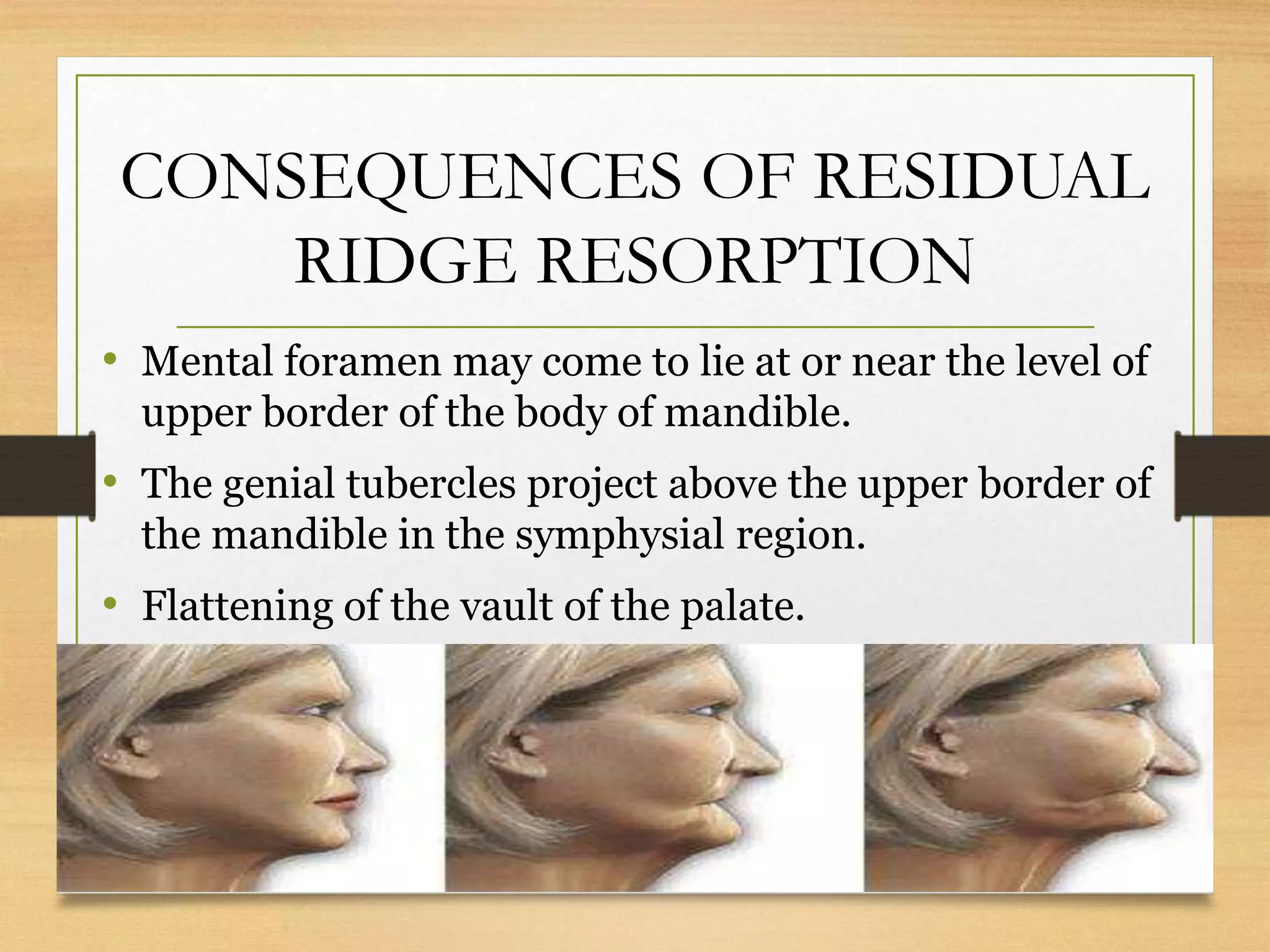 Residual ridge resorption | PPTX