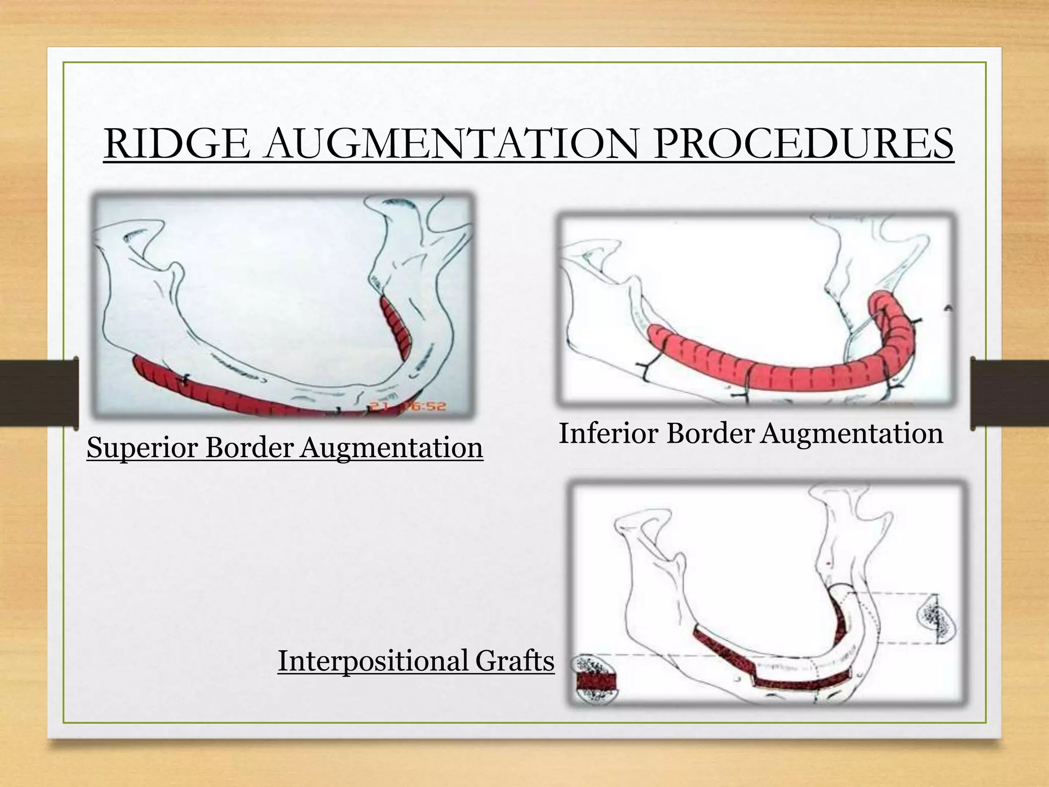 Residual ridge resorption | PPTX | Dental Health | Diseases and Conditions