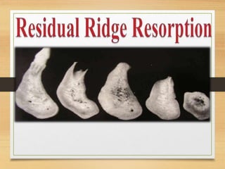 Residual ridge resorption | PPTX