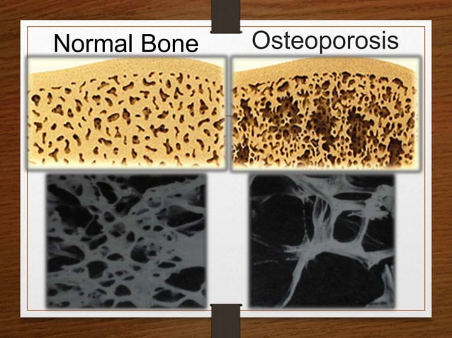 Residual ridge resorption | PPTX | Dental Health | Diseases and Conditions