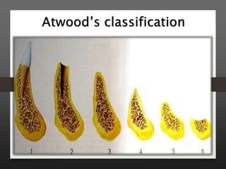 Residual ridge resorption | PPTX