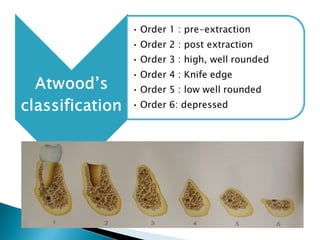 PROSTHODONTIC MANAGEMENT OF RESIDUAL RIDGE REDUCTION | PPT