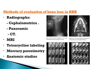 PROSTHODONTIC MANAGEMENT OF RESIDUAL RIDGE REDUCTION | PPT