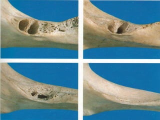 PROSTHODONTIC MANAGEMENT OF RESIDUAL RIDGE REDUCTION | PPT
