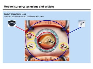 Resight VIUALIZATION SYSTEM FOR RETINAL SURGERY-AJAY DUDANI | PPTX