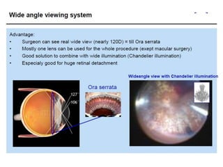 Resight VIUALIZATION SYSTEM FOR RETINAL SURGERY-AJAY DUDANI | PPTX