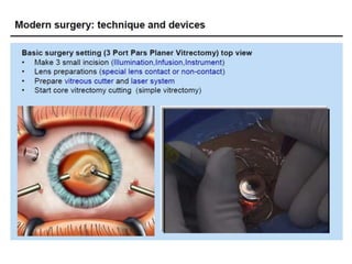 Resight VIUALIZATION SYSTEM FOR RETINAL SURGERY-AJAY DUDANI | PPTX