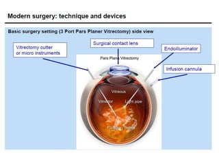 Resight VIUALIZATION SYSTEM FOR RETINAL SURGERY-AJAY DUDANI | PPTX