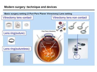 Resight VIUALIZATION SYSTEM FOR RETINAL SURGERY-AJAY DUDANI | PPTX