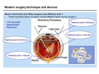 Resight VIUALIZATION SYSTEM FOR RETINAL SURGERY-AJAY DUDANI | PPTX
