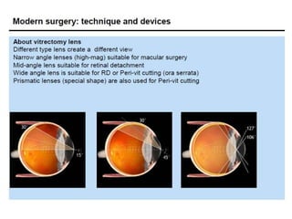 Resight VIUALIZATION SYSTEM FOR RETINAL SURGERY-AJAY DUDANI | PPTX