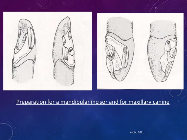 resin-bonded-fpd fixed denture.pptx (1).pdf