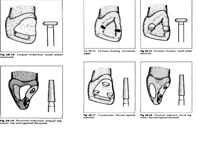 Resin bonded FPDs | PPT | Dental Health | Diseases and Conditions