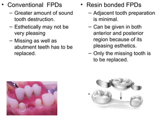 Resin bonded FPDs | PPT