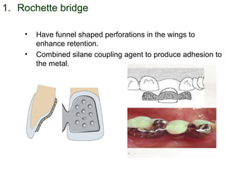Resin bonded FPDs | PPT