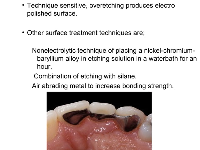 Resin bonded FPDs | PPT | Dental Health | Diseases and Conditions
