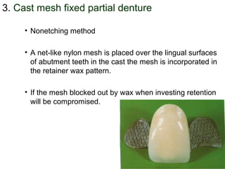 Resin bonded FPDs | PPT