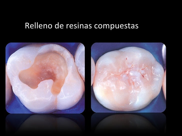 Resina compuesta 2011 rellenos