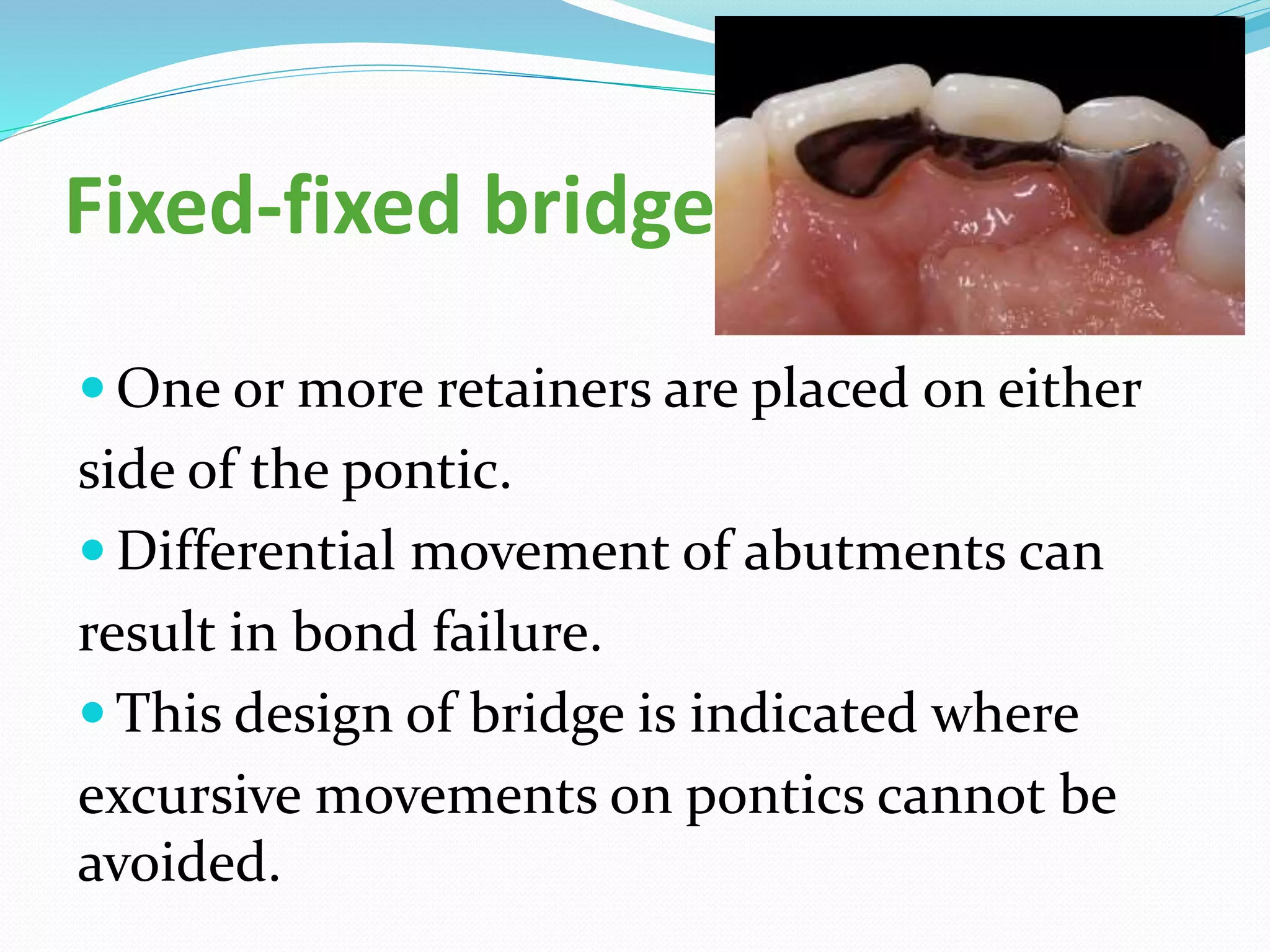 Resin bonded fixed partial denture | PPTX
