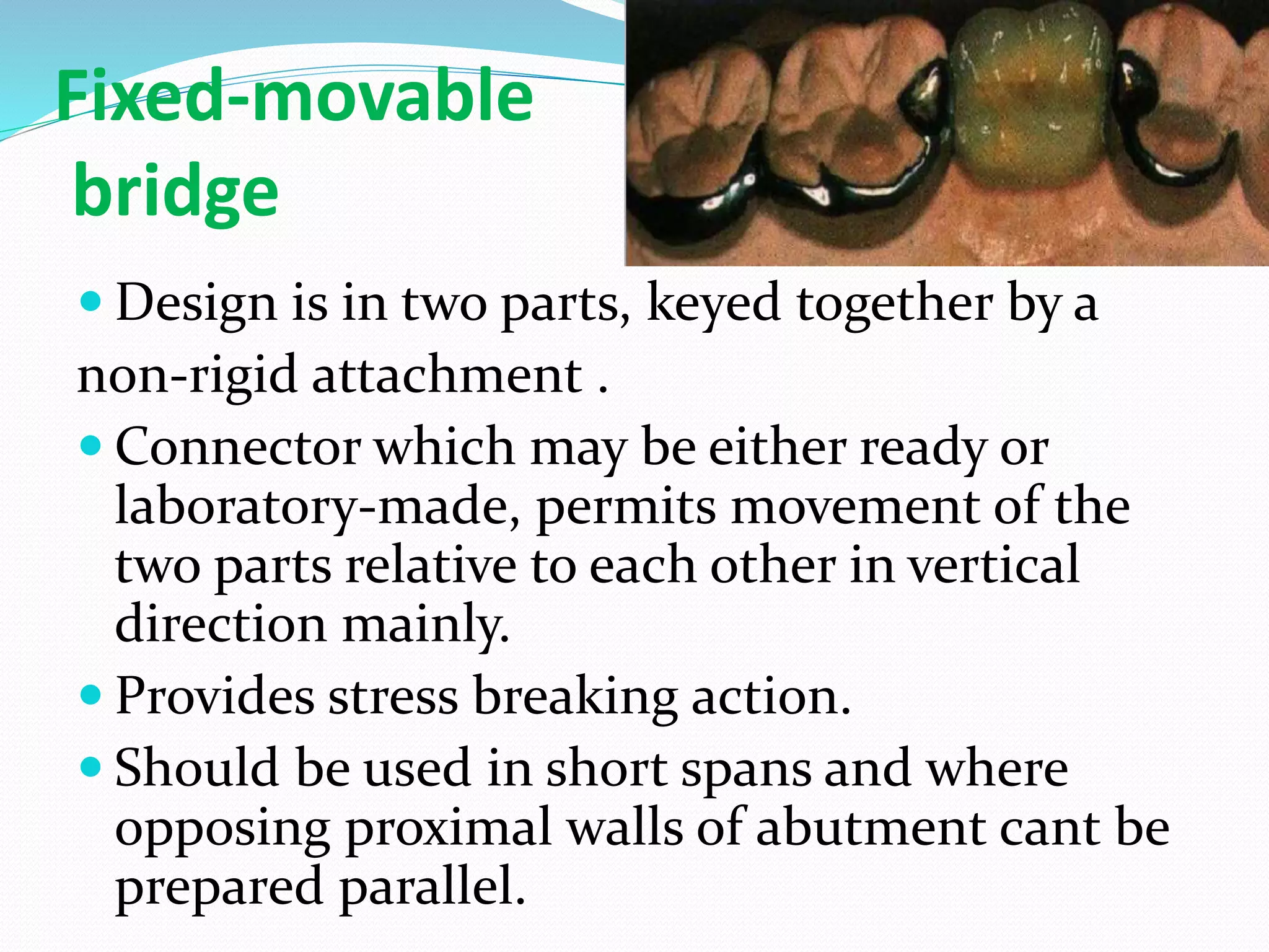 Resin bonded fixed partial denture | PPTX