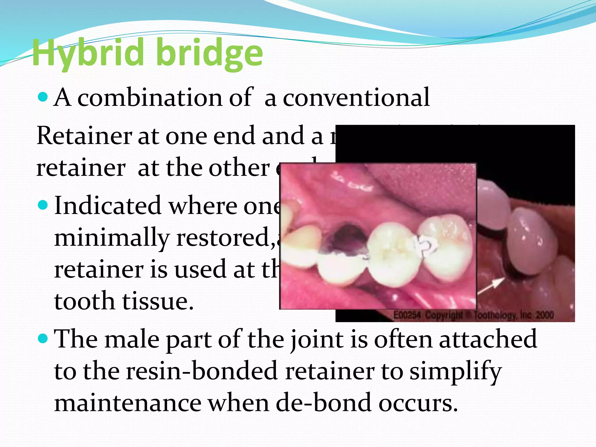 Resin bonded fixed partial denture | PPTX