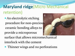 Resin bonded fixed partial denture | PPTX